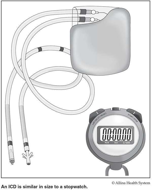 Pacemakers and ICD | Helping Your Heart | Allina Health