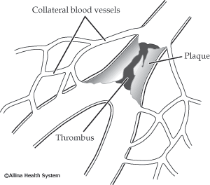 Peripheral Artery Disease (PAD) | Helping Your Heart