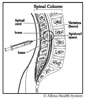 Commonly Questions About An Epidural | Colon Surgery | Allina Health